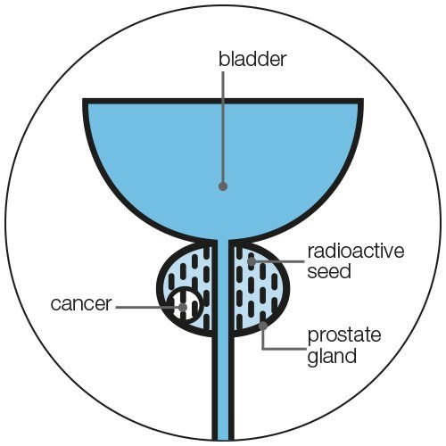Permanent Seed Brachytherapy Prostate Cancer Uk
